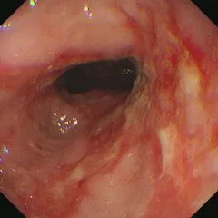 逆流性食道炎 Gastro Esophageal Reflux Disease :GERD 逆流性食道炎 Gastro Esophageal Reflux Disease :GERD