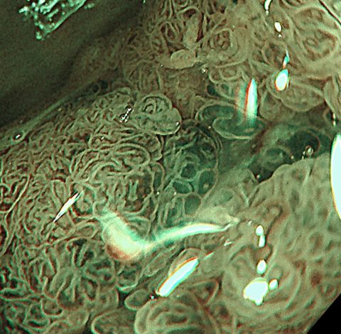 S状結腸癌疑いLST-G(M)(腹部違和感) 年度末の1枚230401④ | まつおか内視鏡内科