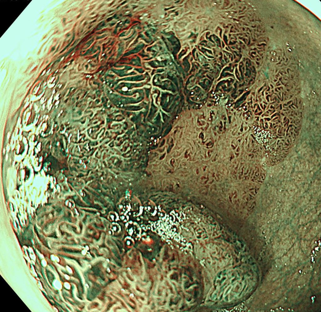 S状結腸LST-G(Mix)(血便、鉄欠乏性貧血) 今週の1枚240529 | まつおか内視鏡内科